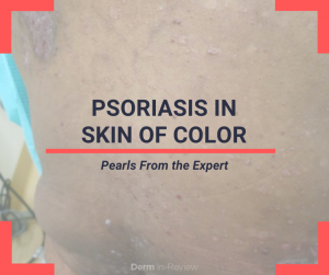 Psoriasis in Skin of Color: Pearls from SOC Update | Skin of Color ...
