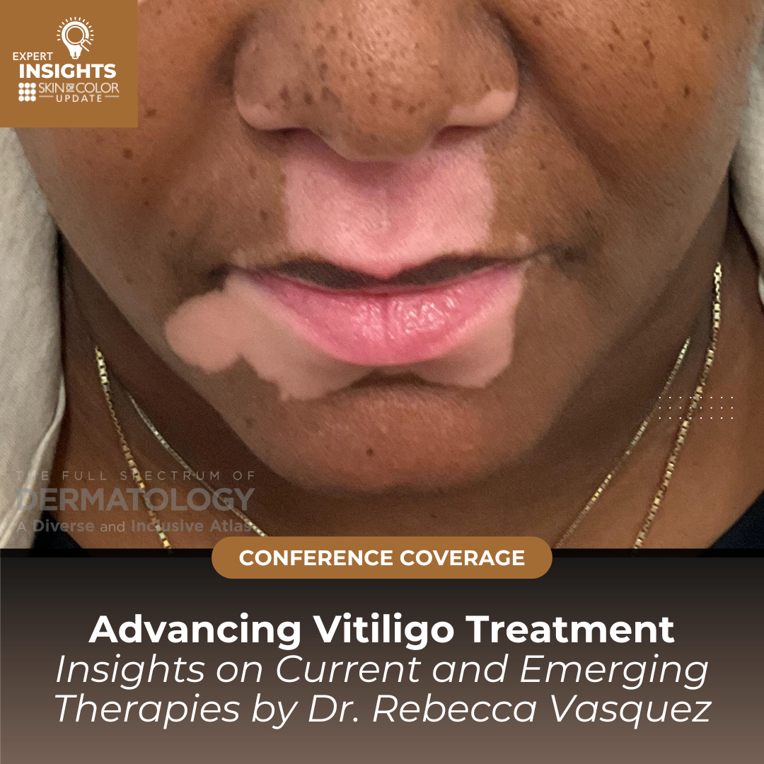 Advancing Vitiligo Treatment: Highlights from SOCU 2024 | Skin of Color ...