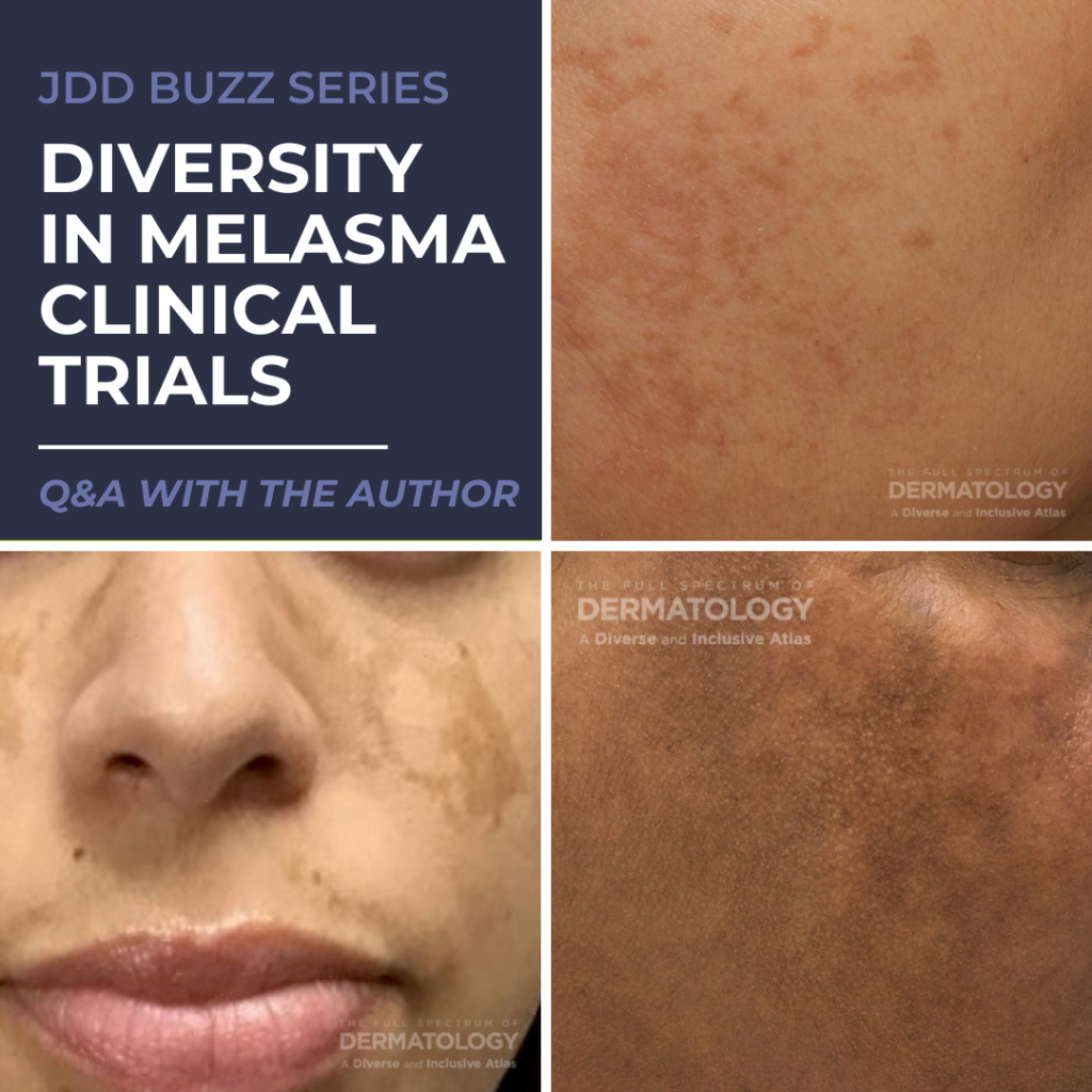 JDD Buzz: Diversity in Melasma Clinical Trials | Skin of Color Update ...