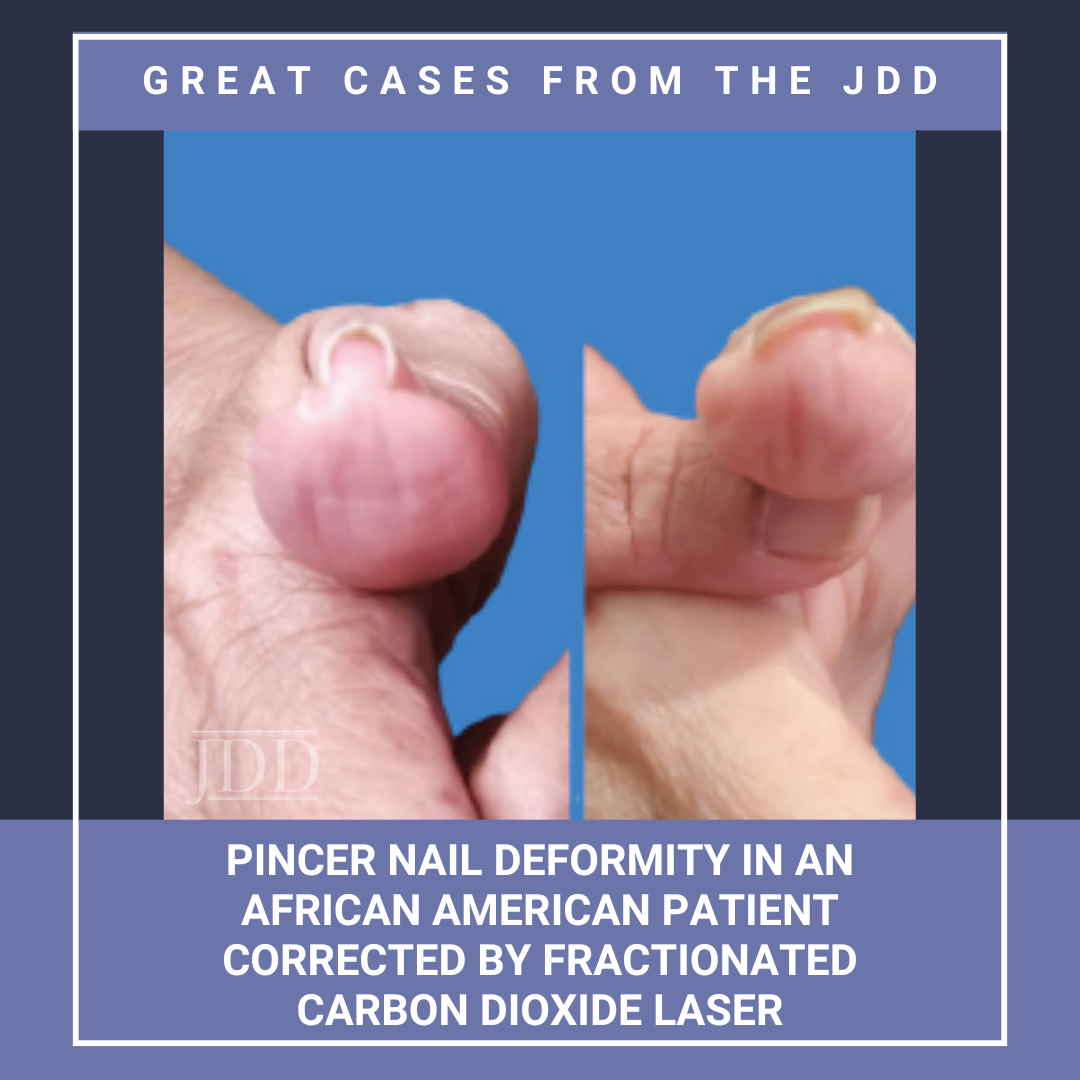 Great Cases from the JDD: Pincer Nail Deformity | Skin of Color Update ...