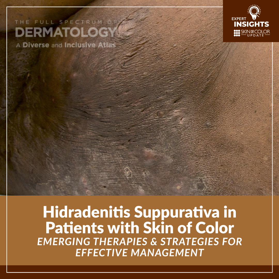 Hidradenitis Suppurativa in Patients with Skin of Color | Skin of Color ...
